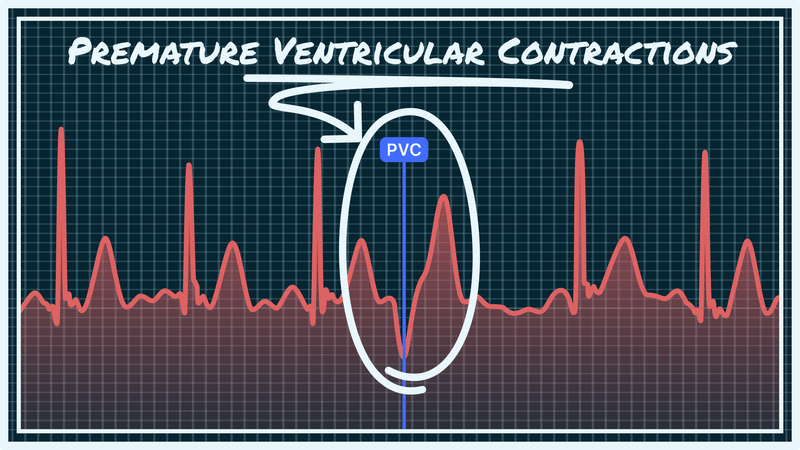 What Premature Ventricular Contraction (PVC) Looks Like on Your Watch ...