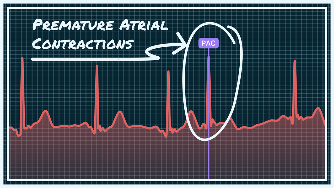 What Premature Atrial Contraction PAC Looks Like On Your Watch ECG Qaly What Premature Atrial Contraction PAC Looks Like On Your Watch ECG Qaly