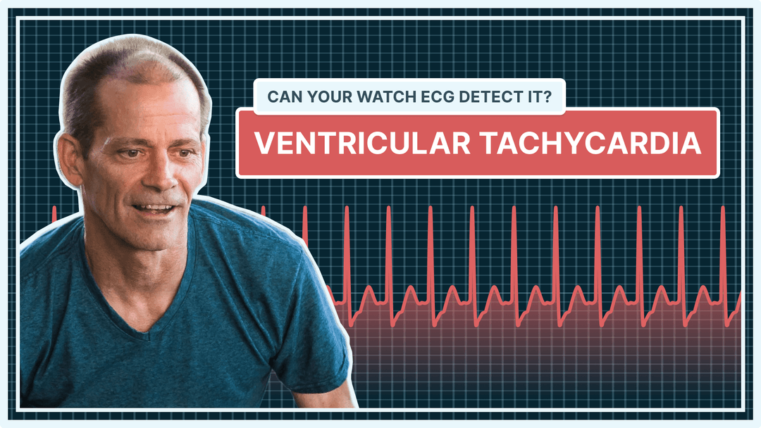 QALY | What Ventricular Tachycardia (Vtach) Looks Like on Your Watch ECG