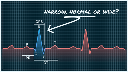 QALY | QRS Interval on Your Watch ECG (Narrow, Normal, and Wide)