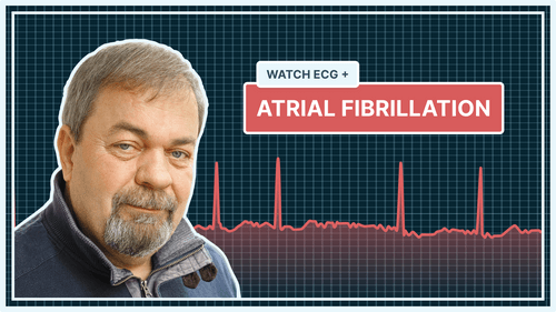 QALY | What Atrial Fibrillation (Afib) Looks Like on Your Watch ECG