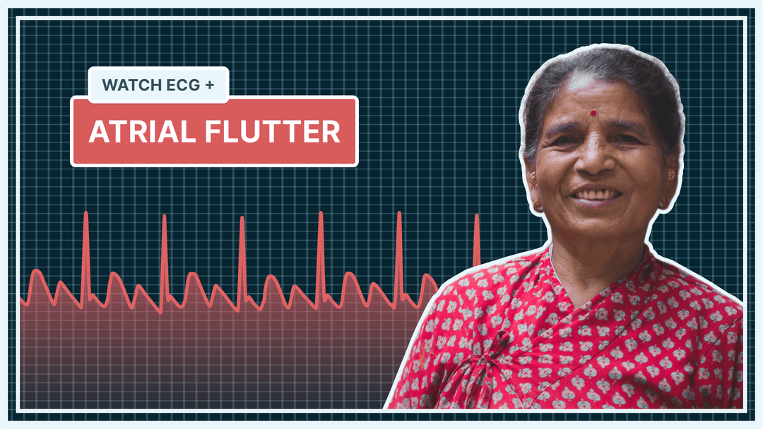QALY | What Atrial Flutter Looks Like on Your Watch ECG