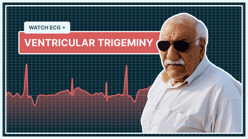 QALY | What Ventricular Trigeminy Looks Like on Your Watch ECG