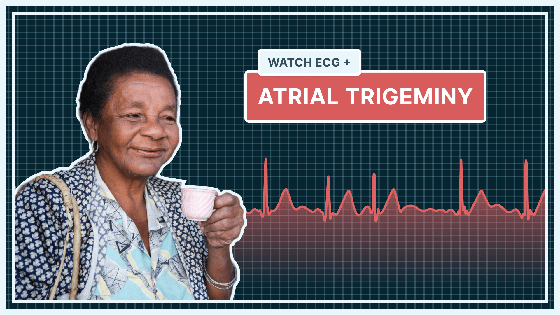 QALY | What Atrial Trigeminy Looks Like on Your Watch ECG