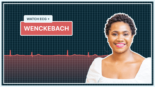 QALY | What Second Degree AV Block Type 1 (Wenckebach) Looks Like on ...