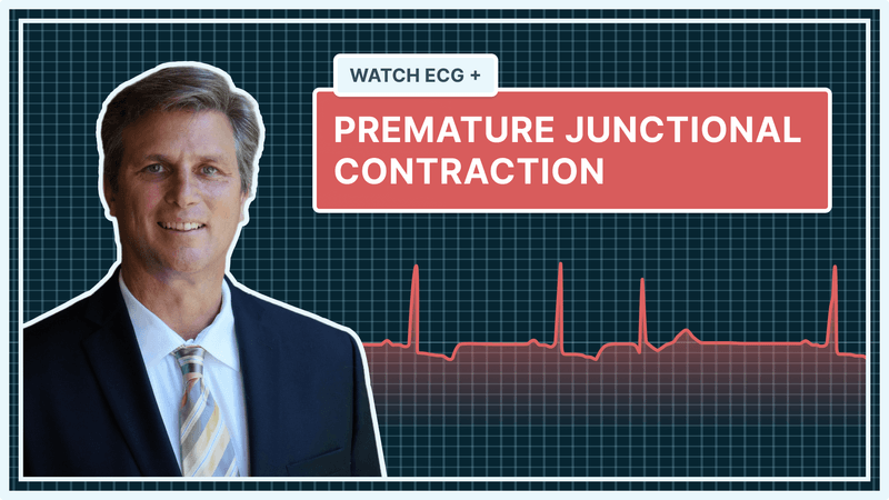 QALY | What a Premature Junctional Contraction (PJC) Looks Like on Your ...