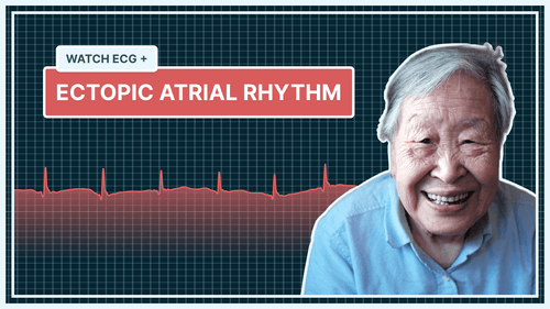 QALY | What Ectopic Atrial Rhythm Looks Like on Your Watch ECG