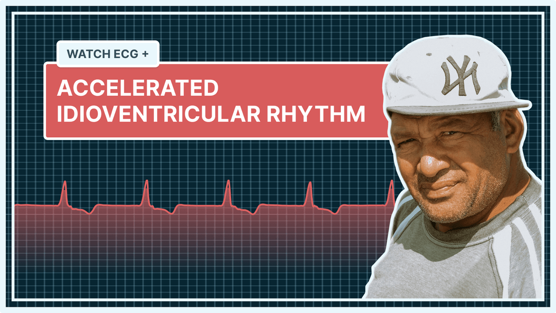 QALY | What Accelerated Idioventricular Rhythm Looks Like on Your Watch ECG