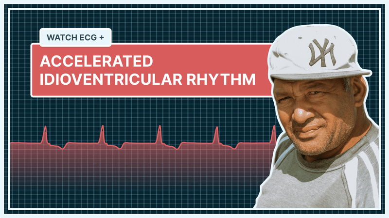 QALY | What Accelerated Idioventricular Rhythm Looks Like on Your Watch ECG
