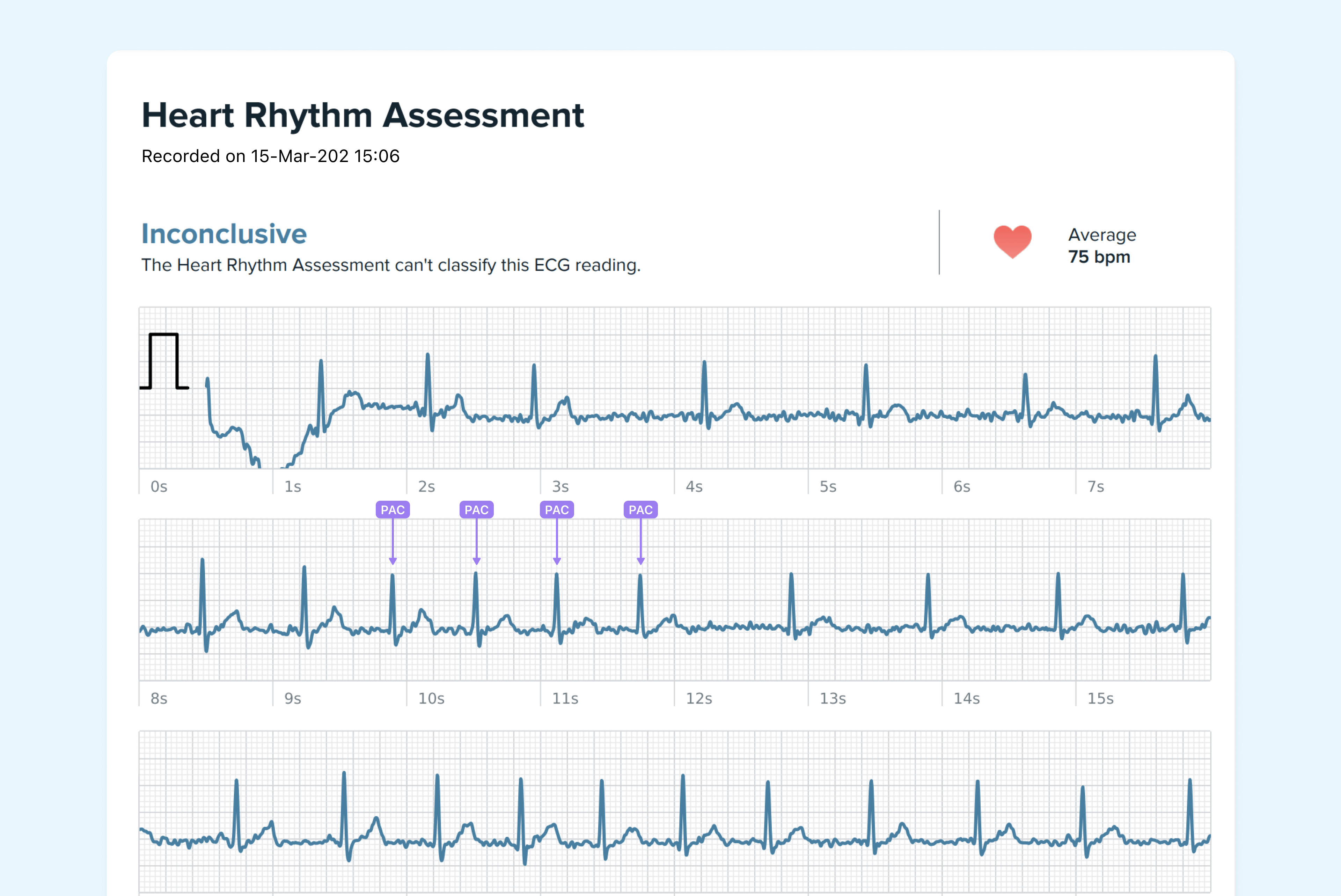 QALY | What Ectopic Atrial Rhythm Looks Like on Your Watch ECG