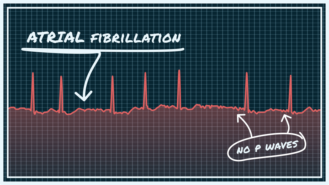 What Atrial Fibrillation (Afib) Looks Like on Your Watch ECG | Qaly