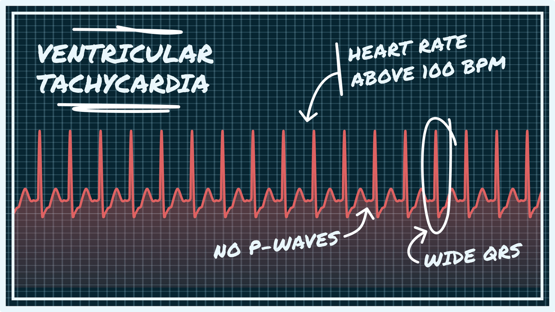 What Ventricular Tachycardia (Vtach) Looks Like on Your Watch ECG | Qaly