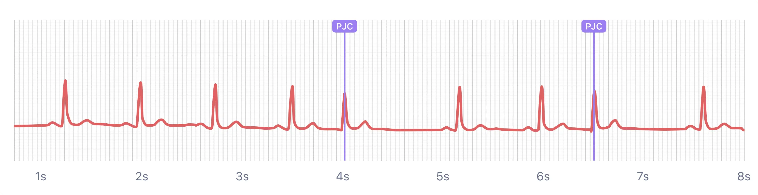 What Premature Junctional Contraction PJC Looks Like On Your Watch