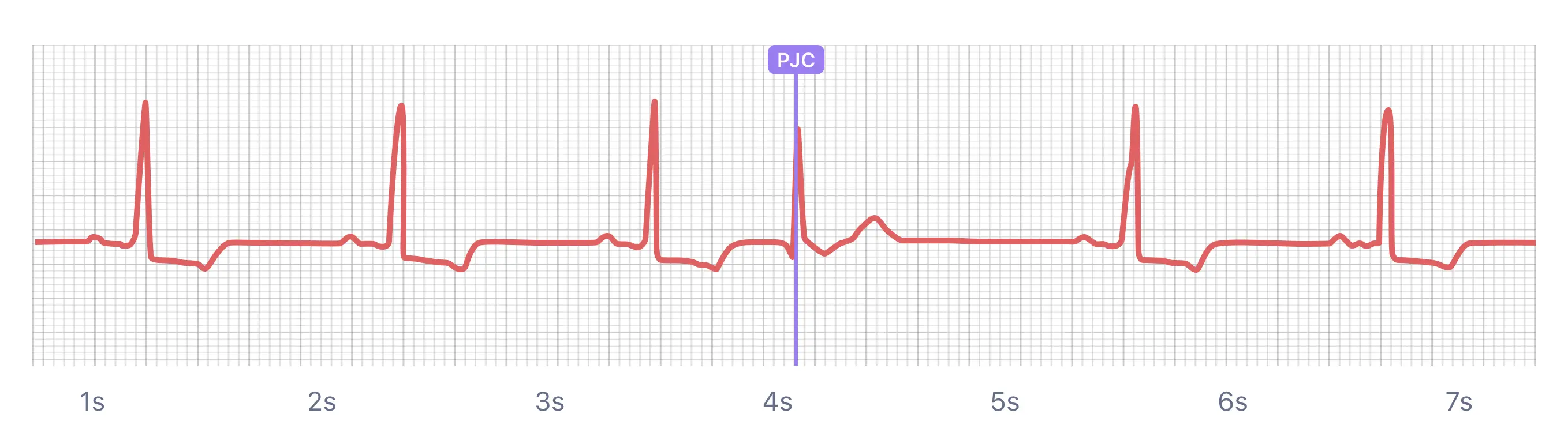 What Premature Junctional Contraction PJC Looks Like On Your Watch