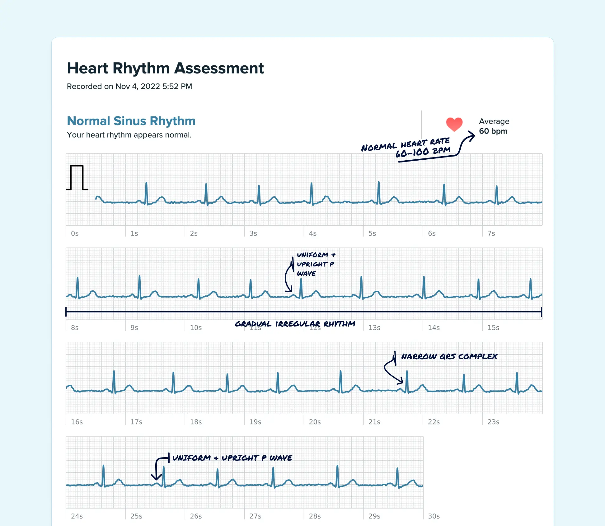 Sinus Arrhythmia Vs Atrial Fibrillation On Your Watch ECG Qaly