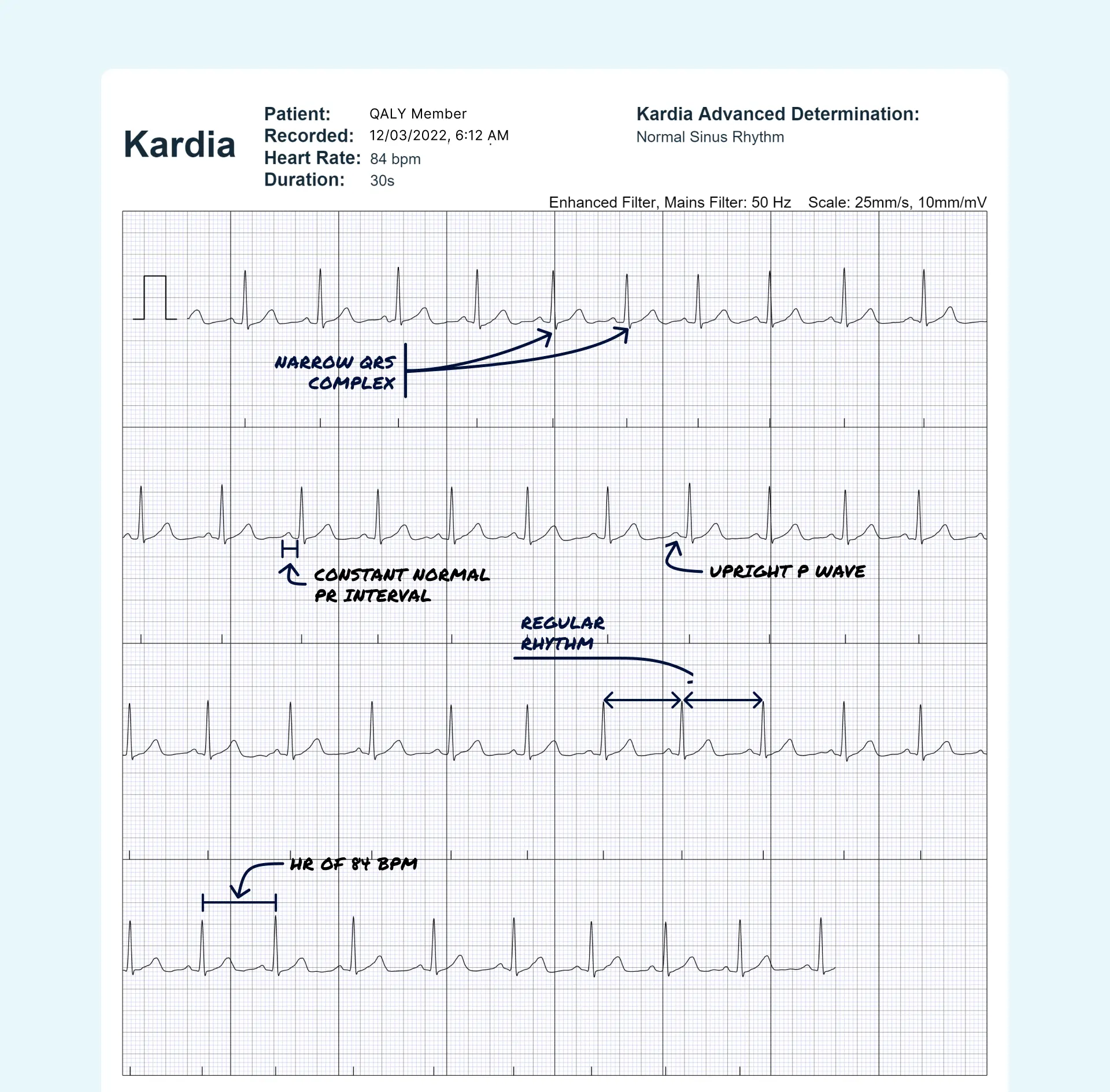 Sinus Rhythm Vs Ventricular Tachycardia Non Sustained On Your Watch Sinus Rhythm Vs Ventricular Tachycardia Non Sustained On Your Watch