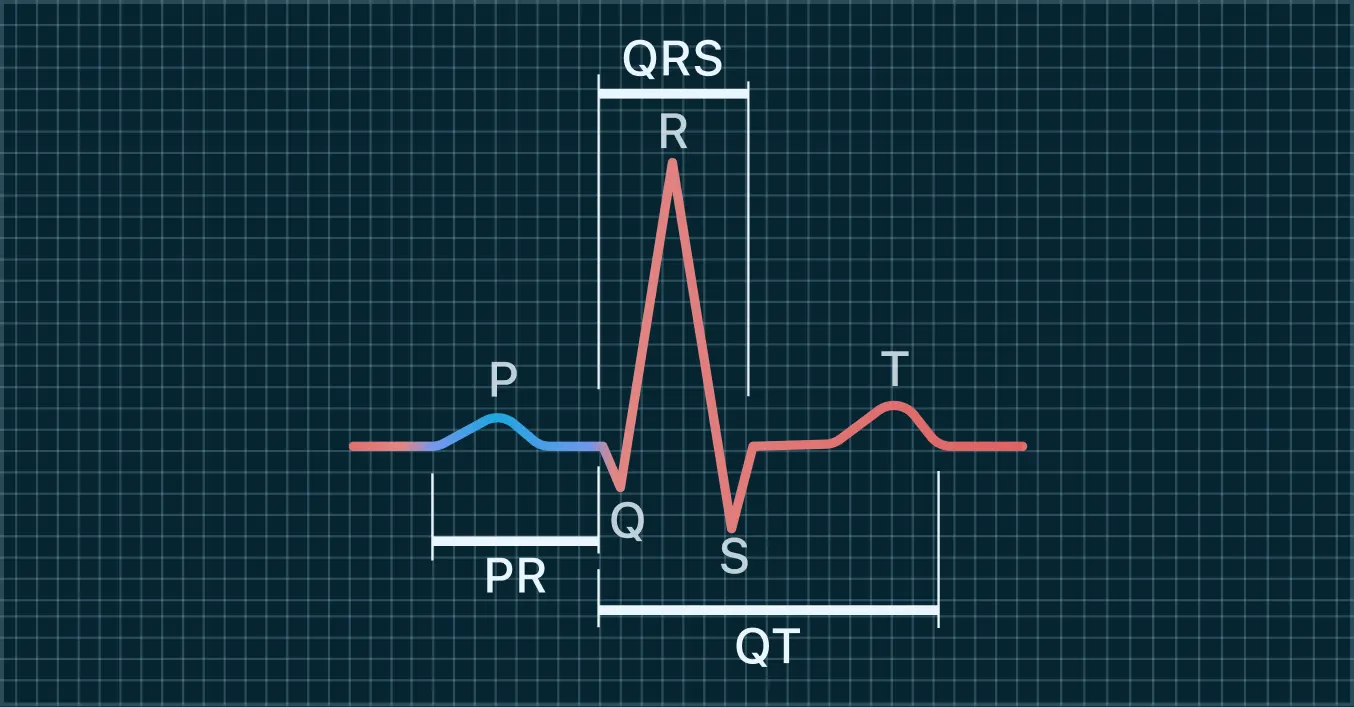 What P Waves Look Like on Your Watch ECG | Qaly