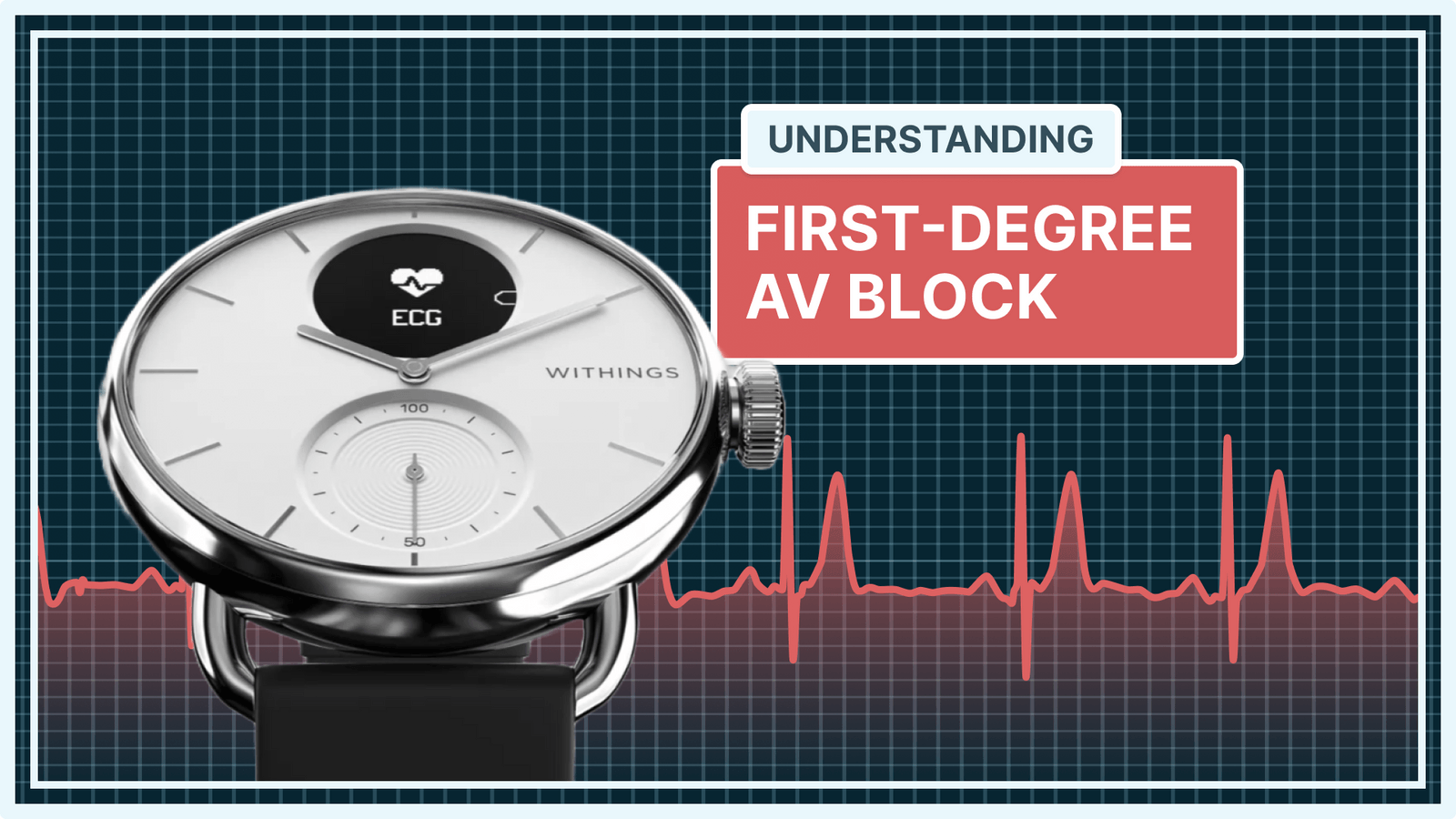 What First-Degree AV Block Looks Like on Your Watch ECG | Qaly
