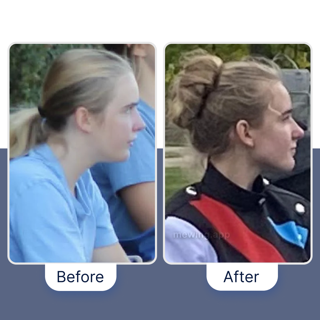 Mewing Before & After: 122+ Progress Photos (Male & Female Transformations)