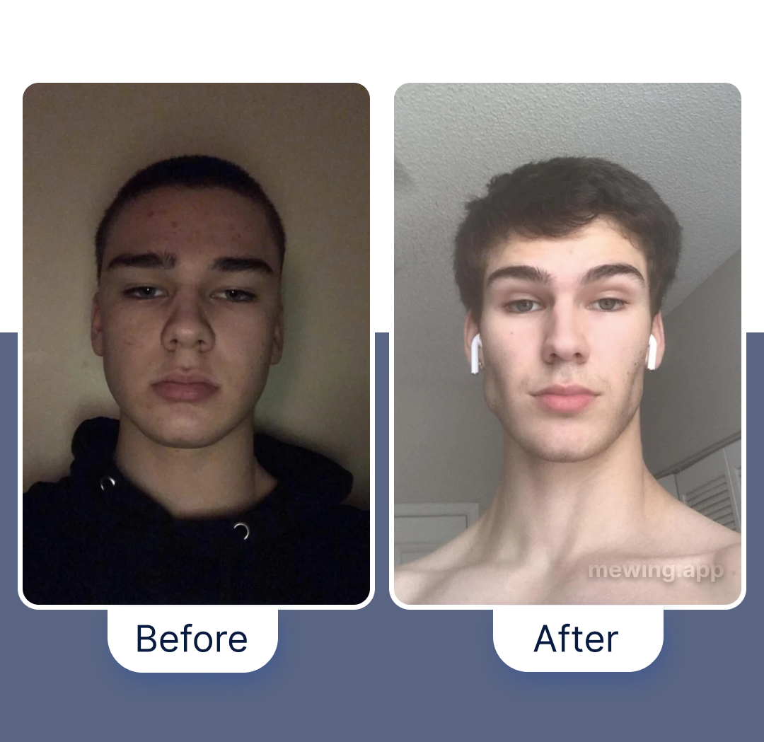 Mewing Before & After: 122+ Progress Photos (Male & Female Transformations)