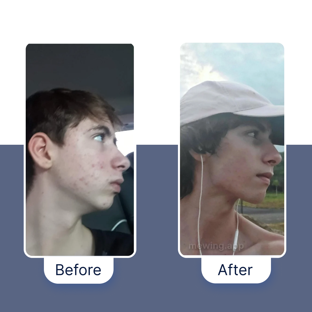 Mewing Before & After: 122+ Progress Photos (Male & Female Transformations)