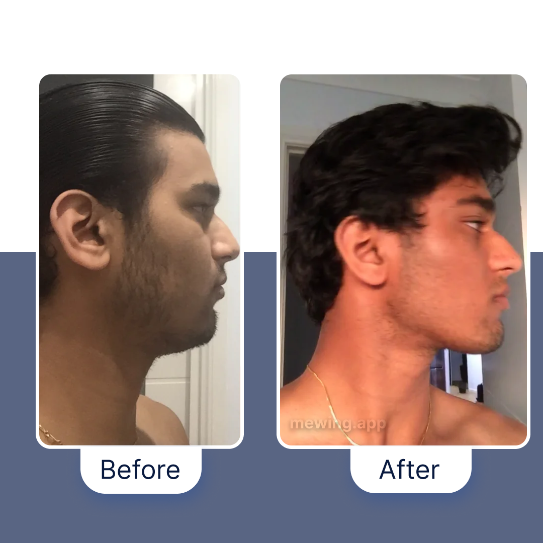 Mewing Before & After: 122+ Progress Photos (Male & Female Transformations)