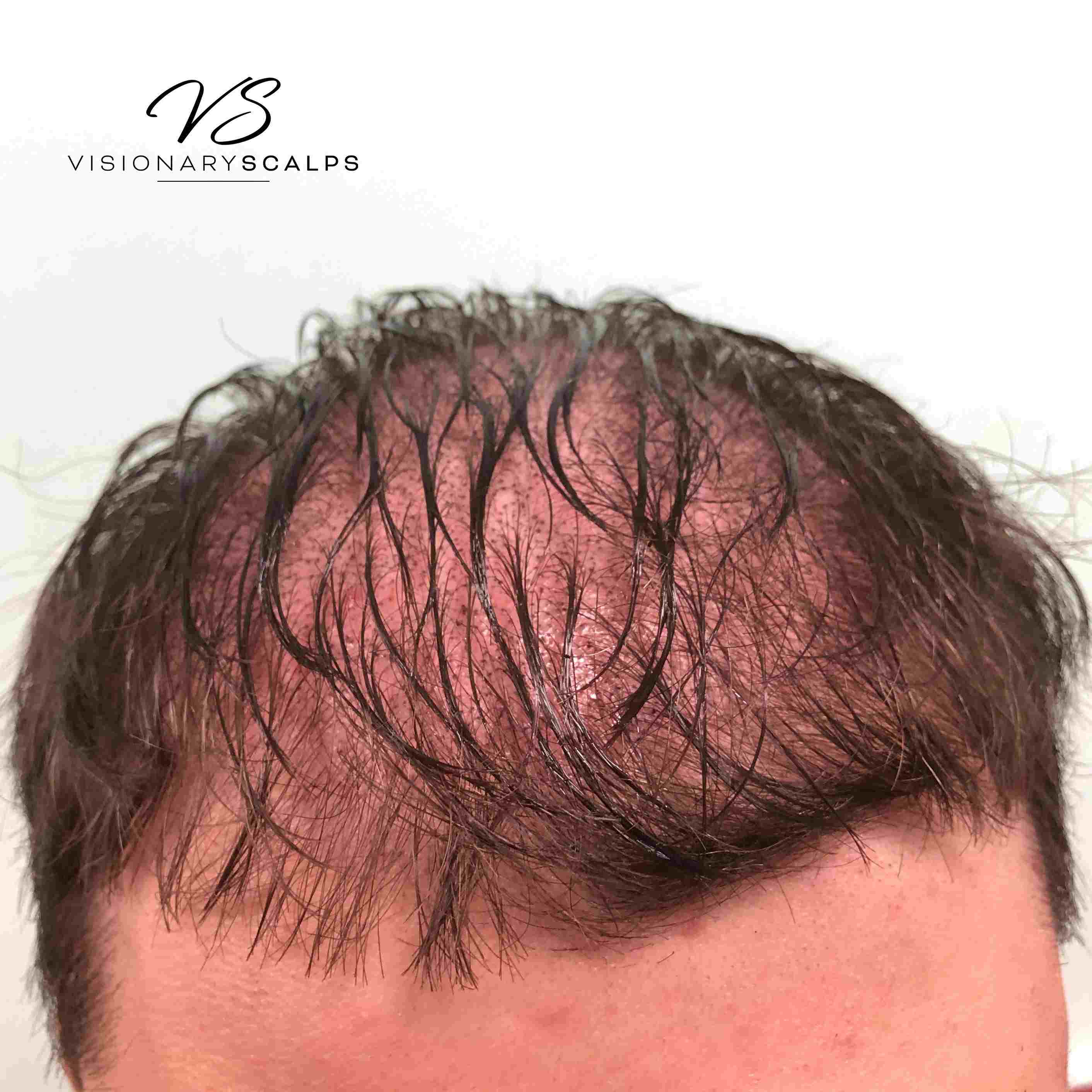 My Hair Is So Thin I Can See My Scalp