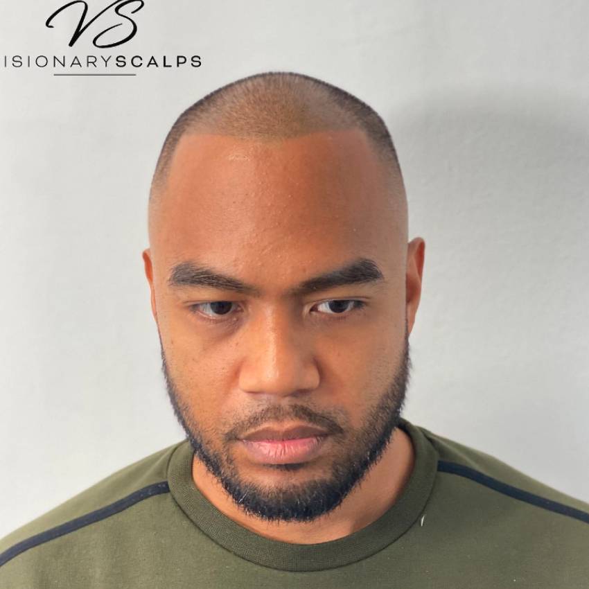 Maturing Hairline vs. Receding Hairline - Visionary scalps