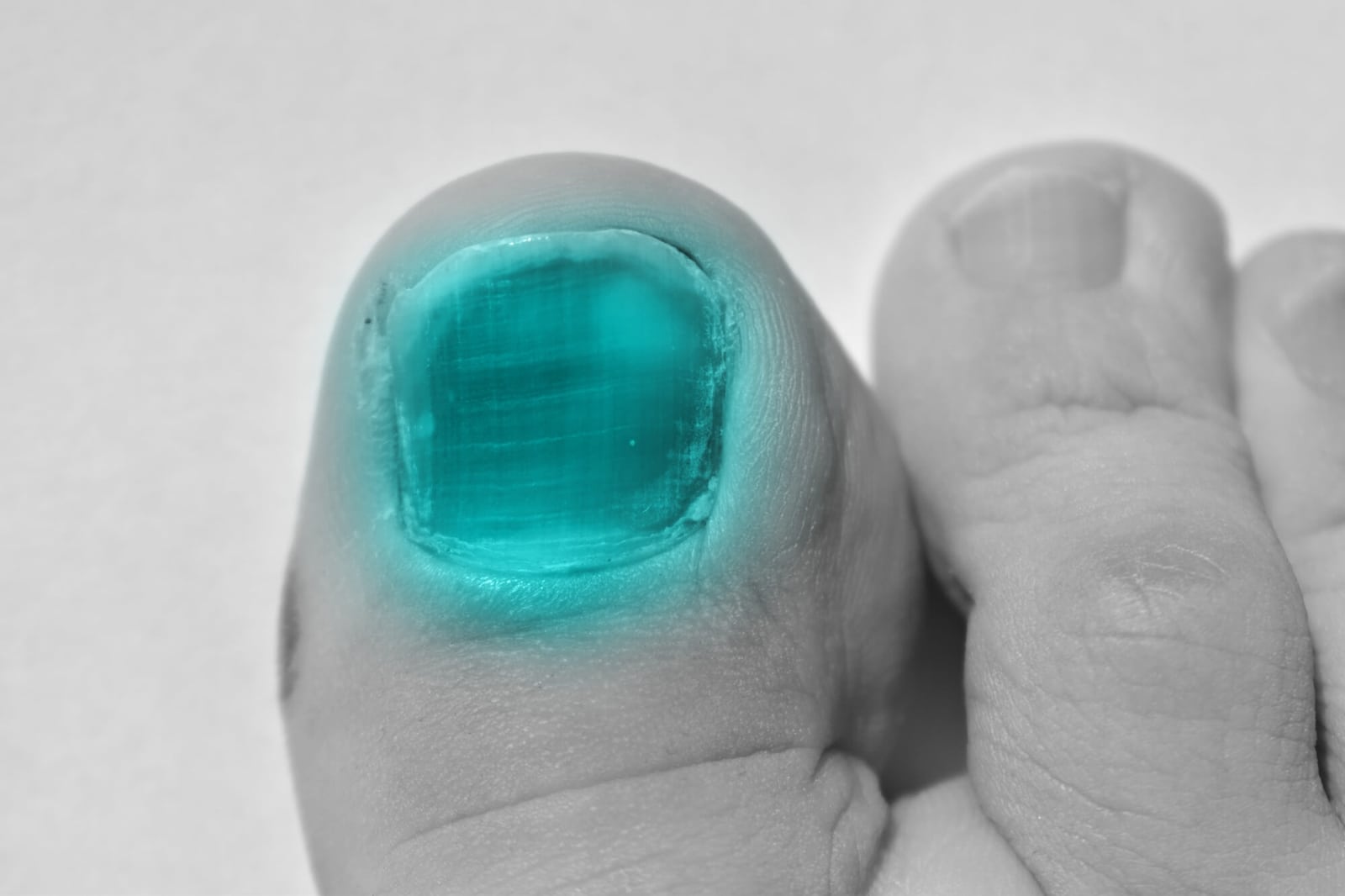 Damaged Toenails | Mississauga Foot Clinic
