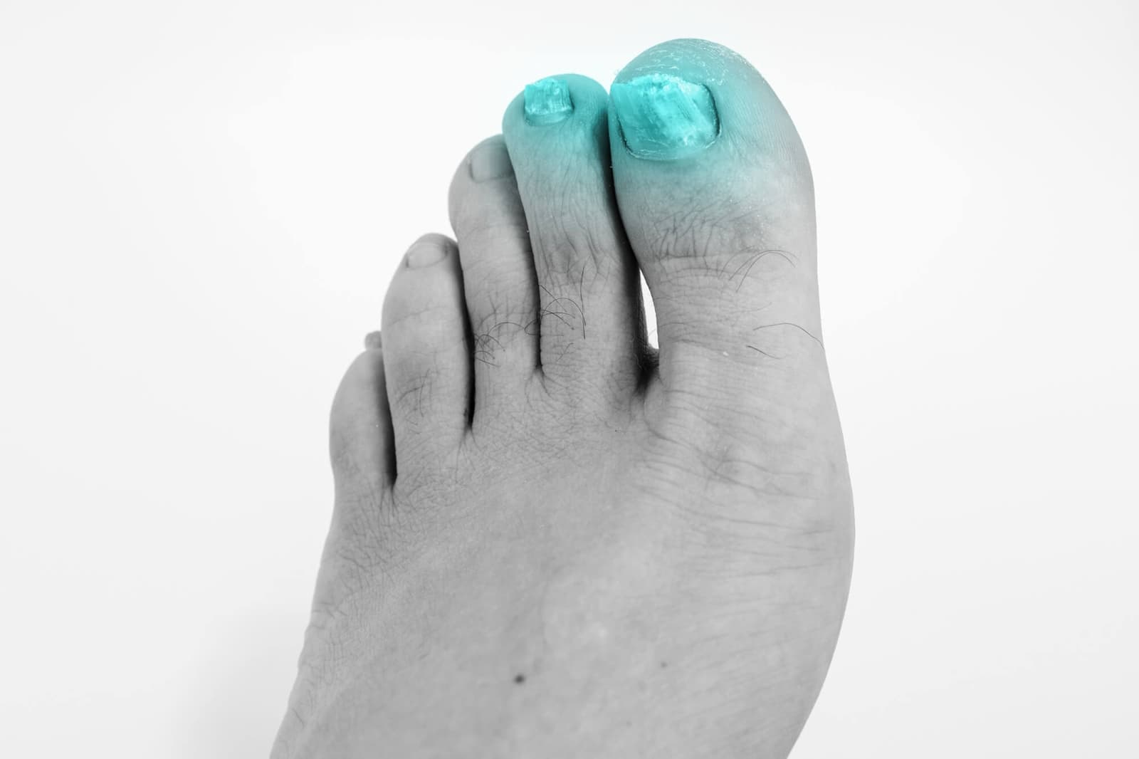 Thickened Toenails | Mississauga Foot Clinic