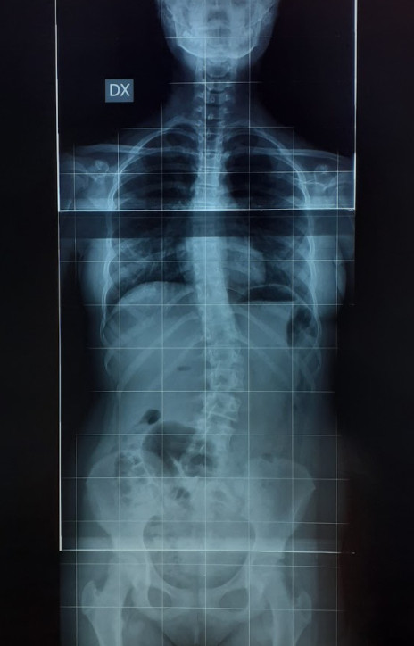 Scoliosi lombare: comprenderla e affrontarla nel modo giusto? - Fisio ...