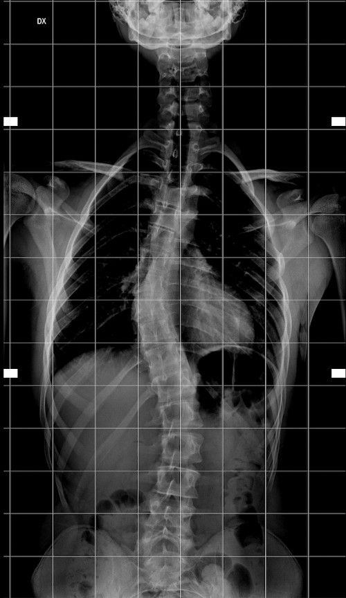 Ecco le foto della scoliosi per conoscerla e non averne paura - Fisio ...