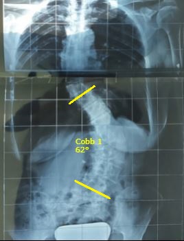 Ecco le foto della scoliosi per conoscerla e non averne paura - Fisio ...
