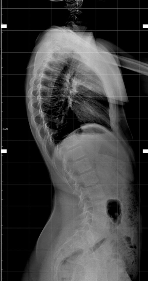 Scoliosi, lordosi e cifosi: affrontiamo questi tre problemi della ...