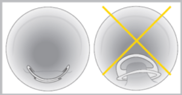 OTSC® Proctology System | Gastroenterology