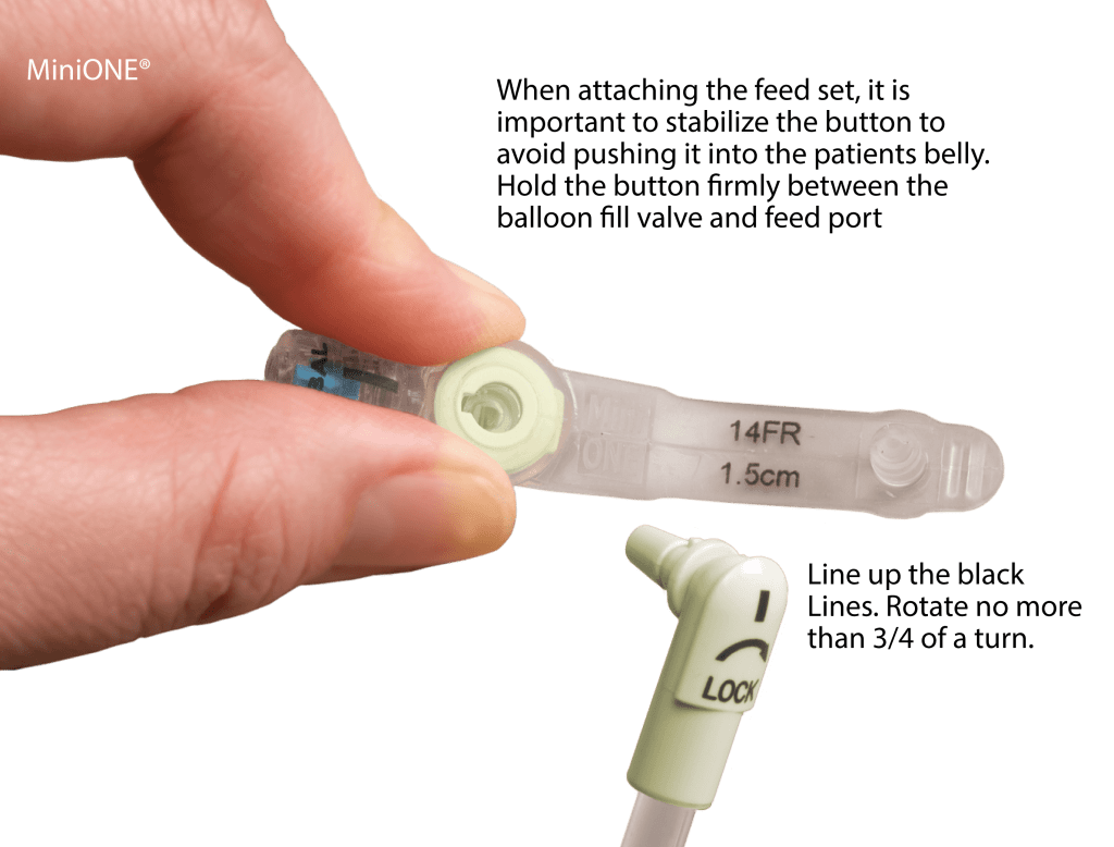 MiniONE® | Enteral Feeding