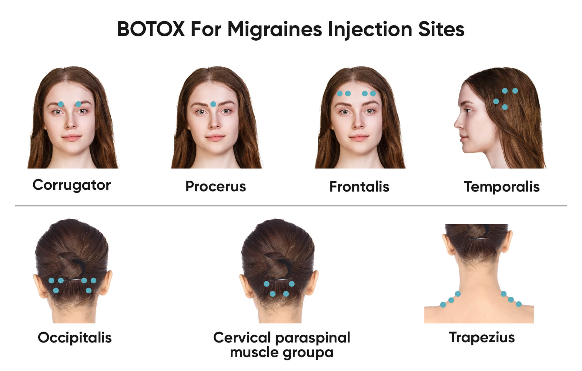 BOTOX For Migraines Bellevue Kirkland Best BOTOX Bellevue