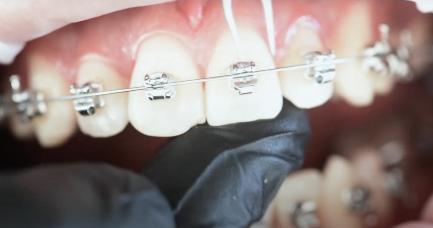 Brackets de autoligado Smile System - Borgatta