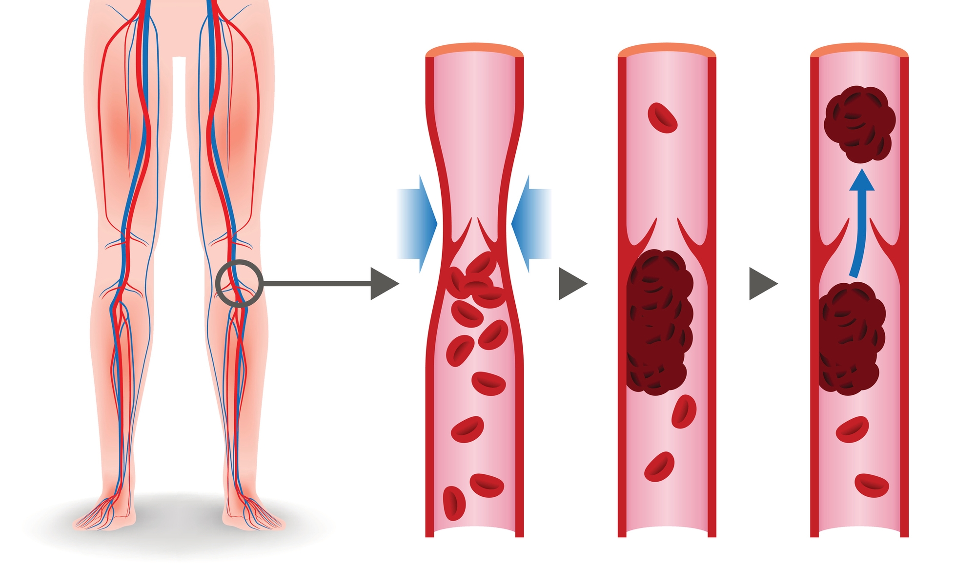What is DVT?