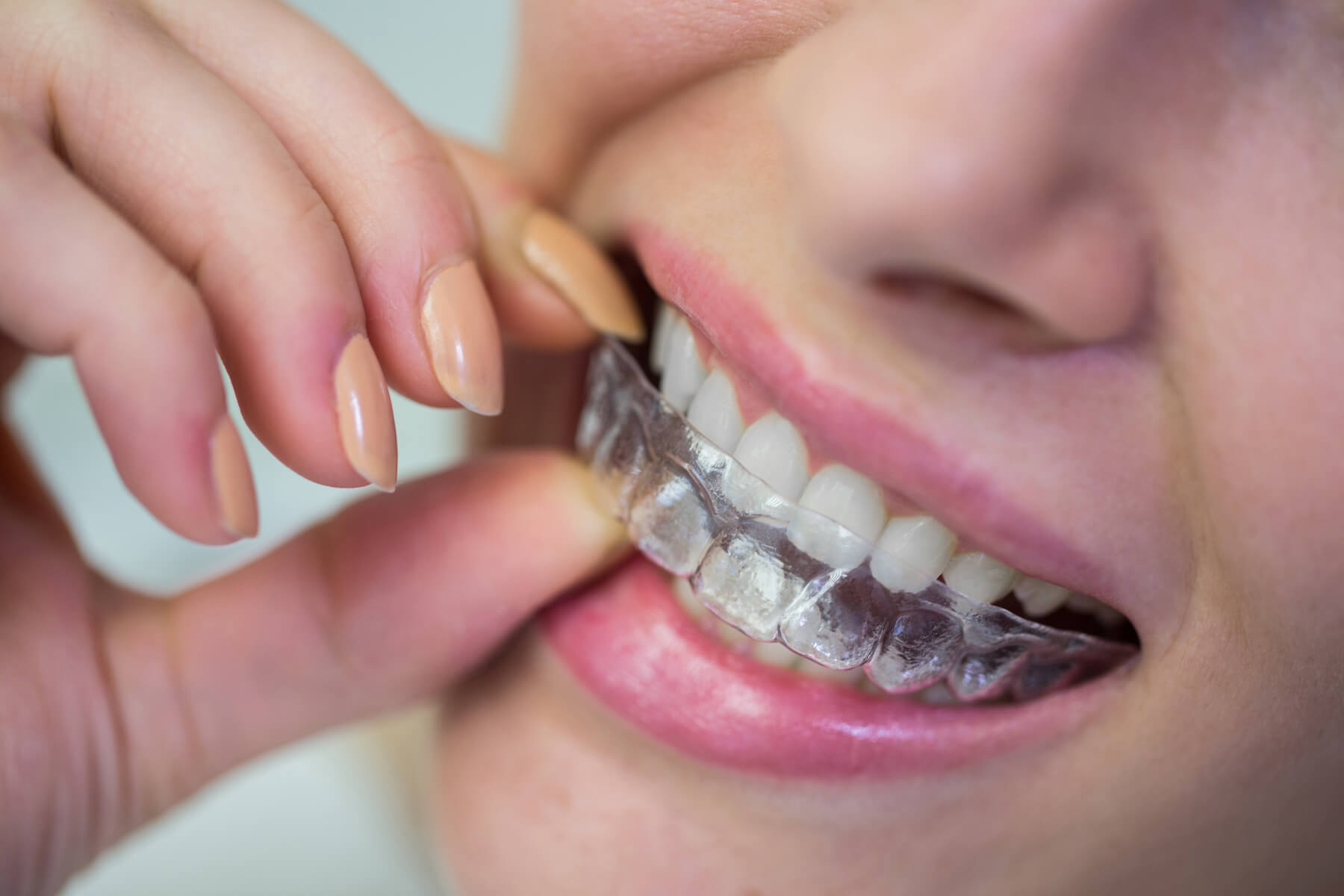 The Benefits of Invisalign for Adults