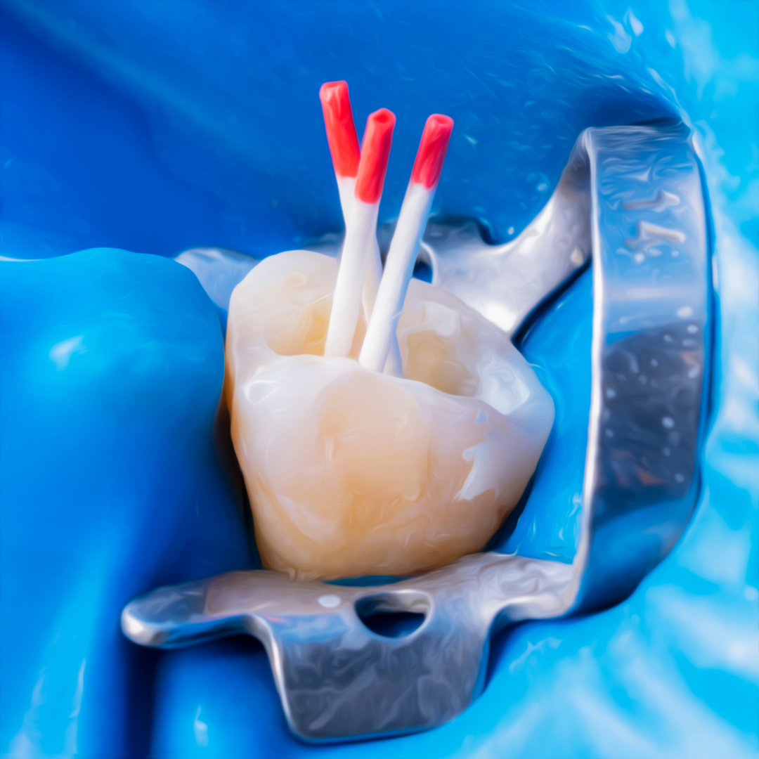 What is a Root Canal | Poole Creek Family Dentistry