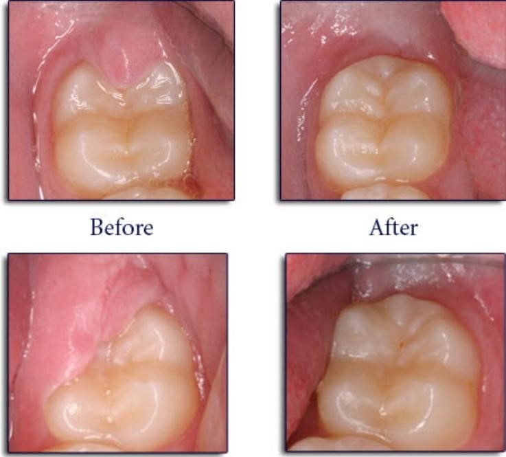 Caredent | Patient Education | Operculectomy