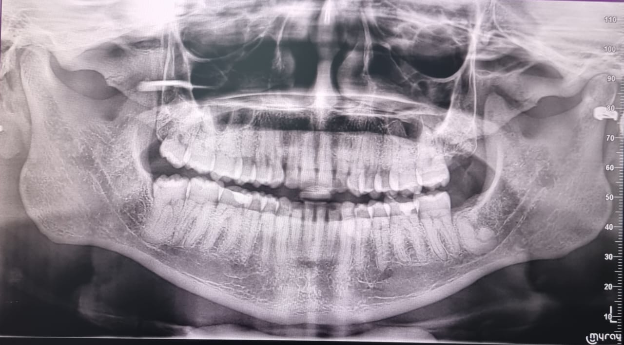 Caredent | Patient Education | DENTAL X-RAY