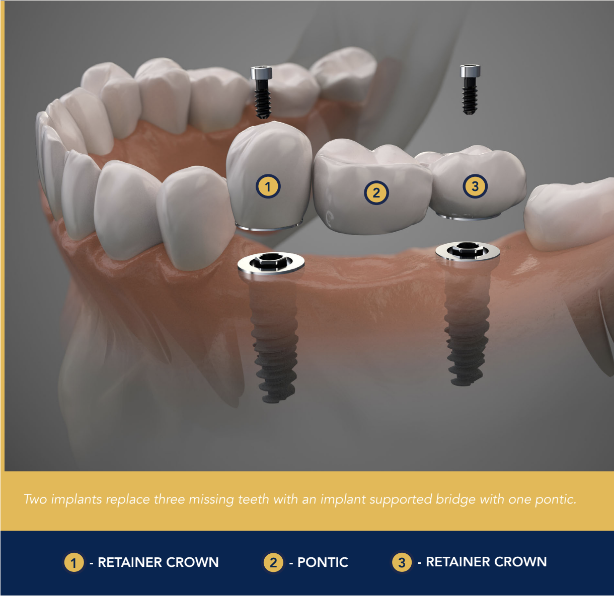 Missing teeth? Here’s why you should replace them