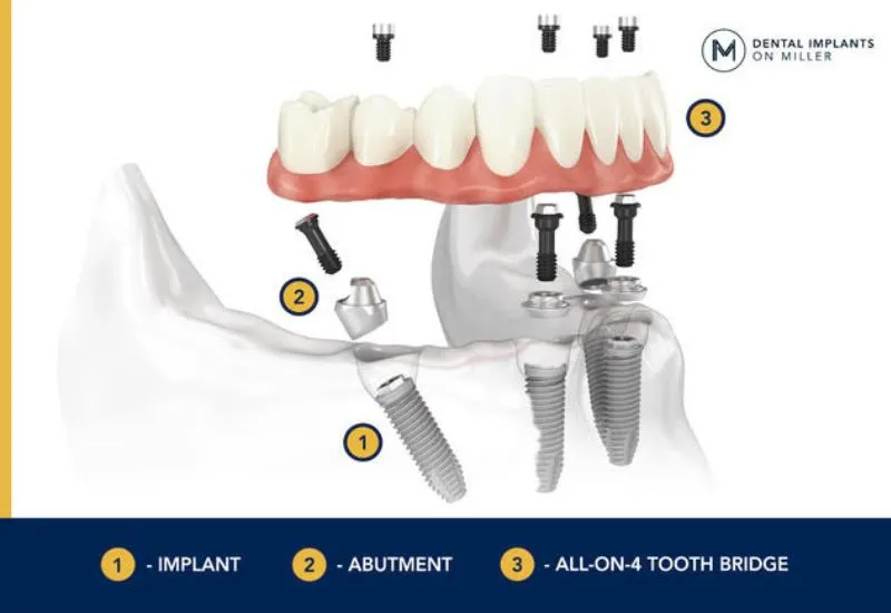 The All on 4 dental implants problems you should know about