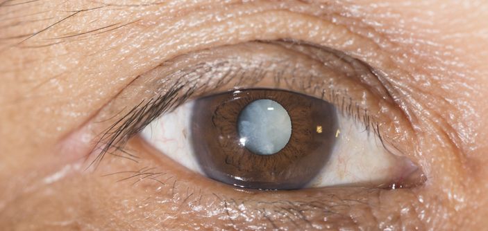 O que é Catarata? Sintomas, Diagnóstico e Tratamento