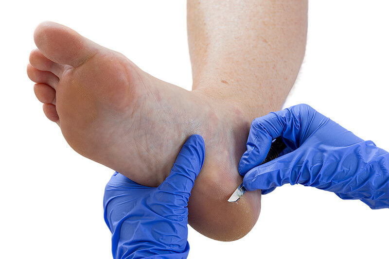 Callus | Diagnosis, Causes & Treatments