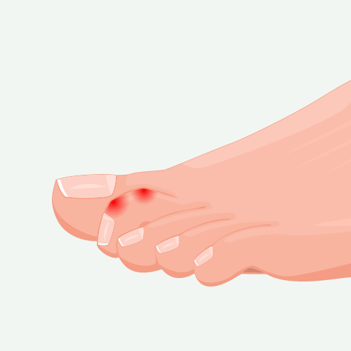Claw toes | Diagnosis, Causes & Treatments