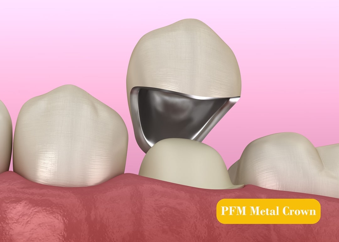 Dental Crowns | Lighthouse Dental Centre | Langley Dentist