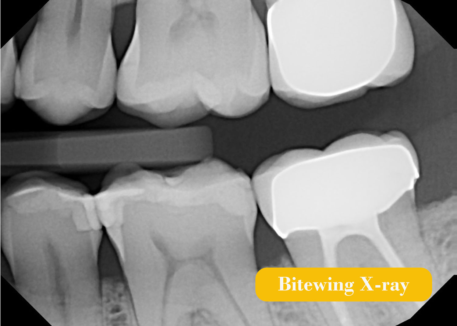 Bitewing X Ray Guidelines Understanding Dental X rays Comprehensive Bitewing X Ray Guidelines Understanding Dental X rays Comprehensive